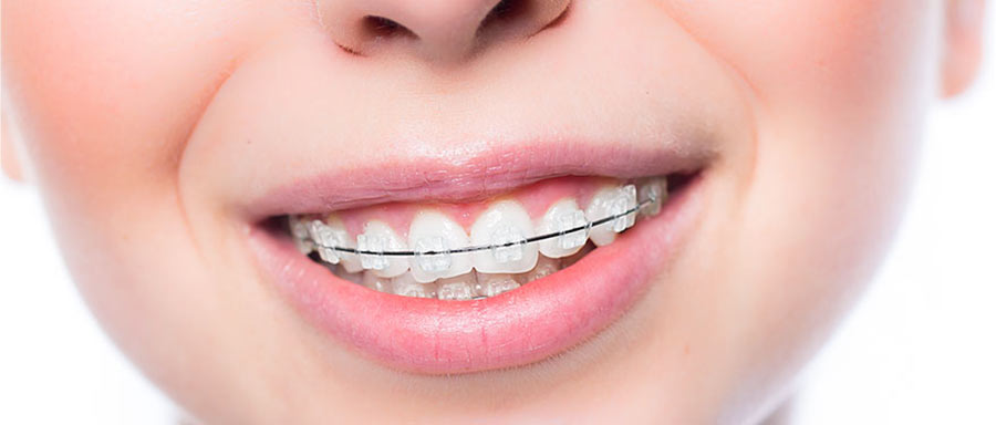Como saber se você precisa de Aparelho Ortodôntico? - O TABOANENSE